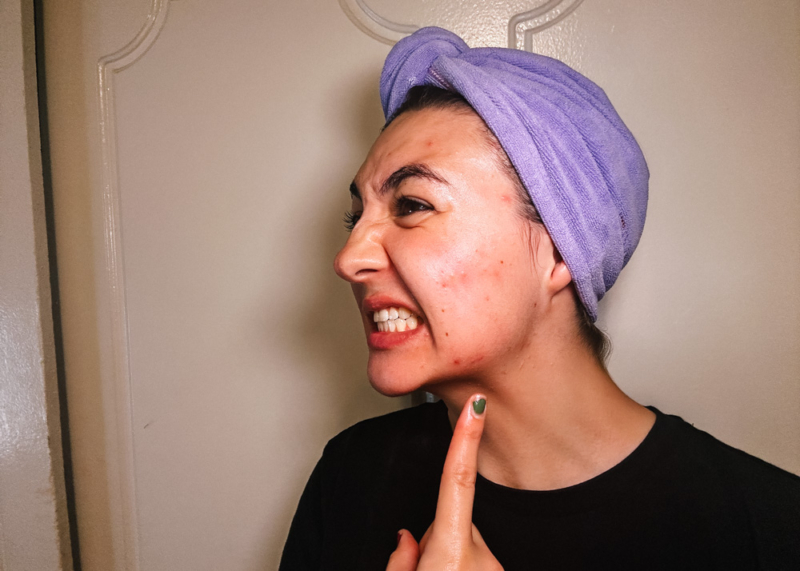 Curology Review After 30+ Days (+ My Curology Before And After!)
