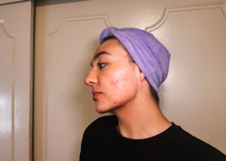 Curology Review After 30+ Days (+ My Curology Before And After!)